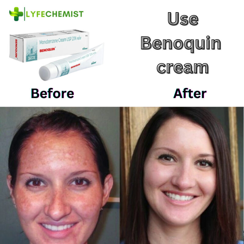 vitiligo Benoquin cream effective treatment